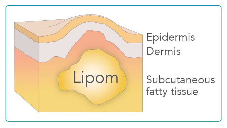 FlexTend for Use with TickleFlex - Diabetic Outlet